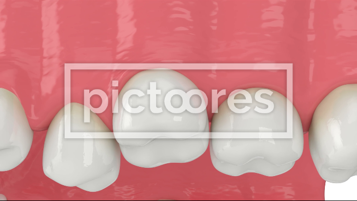 Closeup of upper jaw with abnormal teeth position