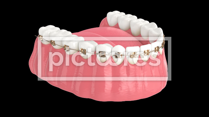 Teeth alignment by orthodontic braces