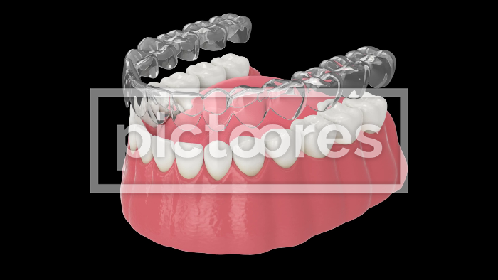 Clear removable aligner placement on lower jaw