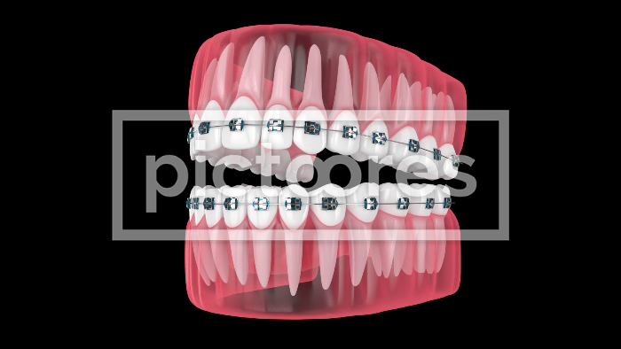 Jaw with teeth and stainless steel orthodontic braces